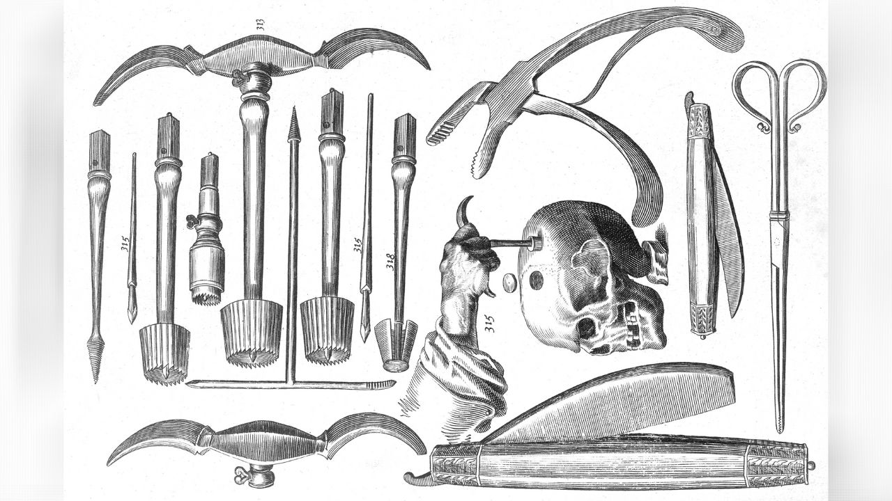Perfurações no crânio: Conheça a trepanação, mais antigo procedimento ...