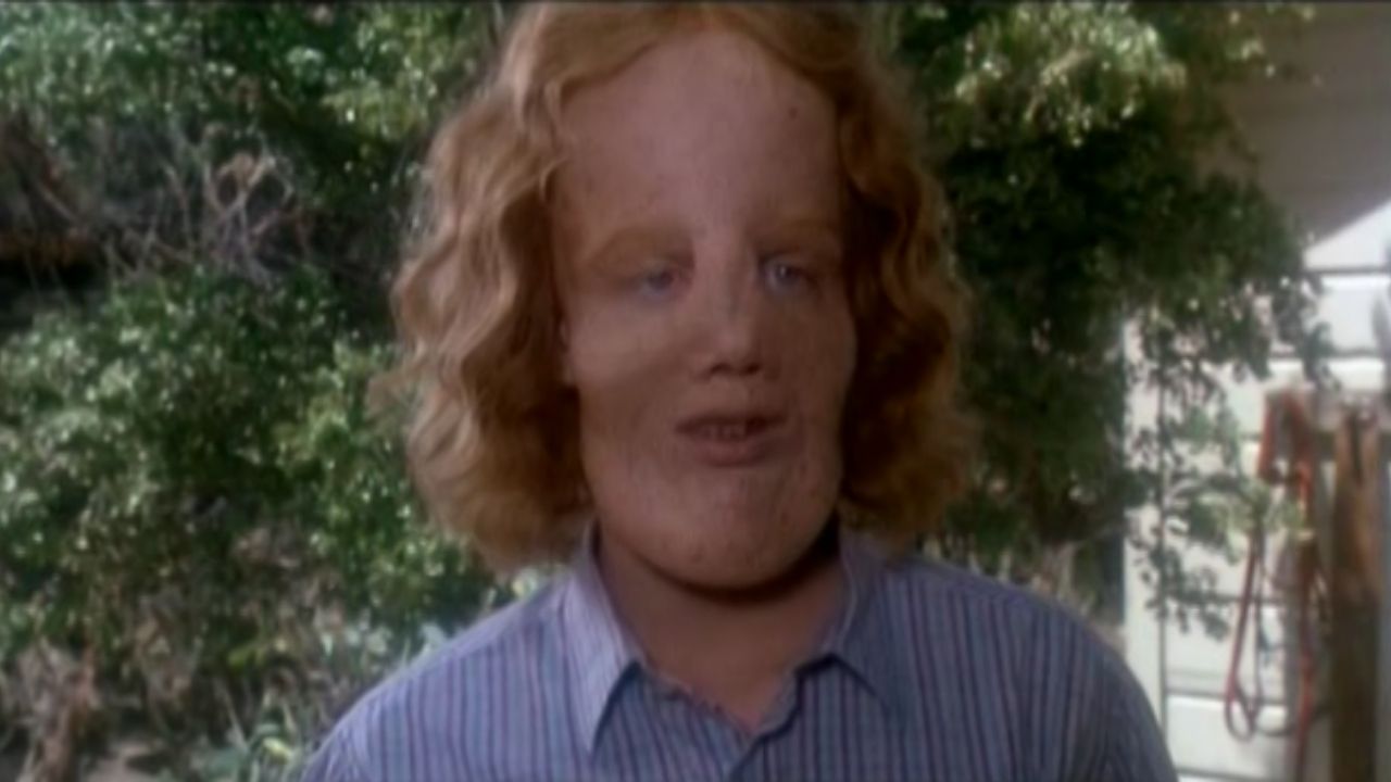 Rocky Dennis: o garoto que teve uma condição rara — e superou ...